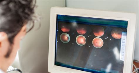 Operculated Retinal Hole In Retinal Detachment Retina