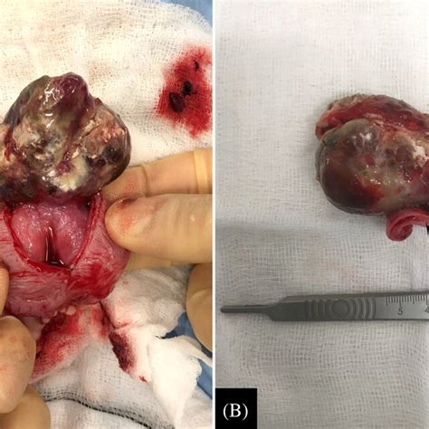 A Intraoperative Appearance Of A Urinary Bladder Hemangiosarcoma In A