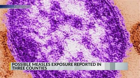 Possible Measles Exposure Reported In Three Nm Counties