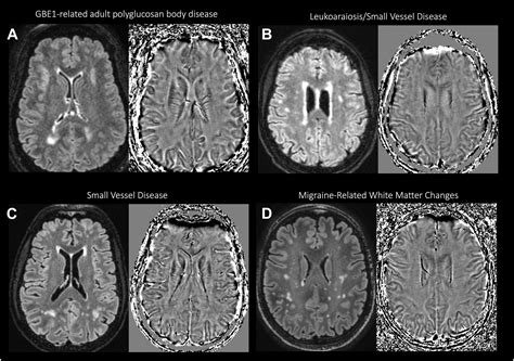 New Imaging Markers In Multiple Sclerosis And Related Disorders