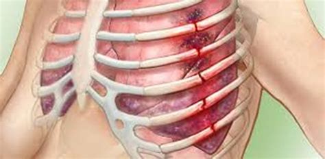 Rib Fractures Frimley Health Nhs Foundation Trust