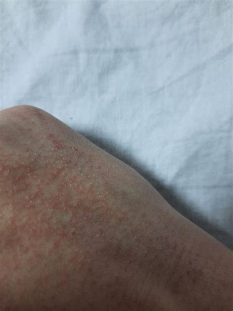 I M Taking Roacutane For 3 Weekend And This Happen On My Hand What Is This R Accutane