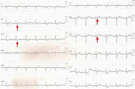 Accelerated Junctional Rhythm Ecg