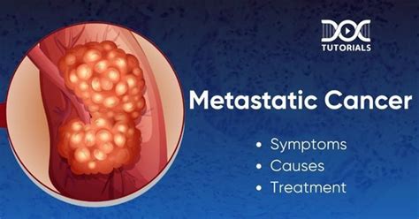 Metastatic Cancer Symptoms Causes And Treatment Options