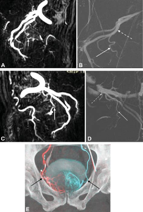 Figure 1 From Prostatic Artery Embolization For Benign Prostatic