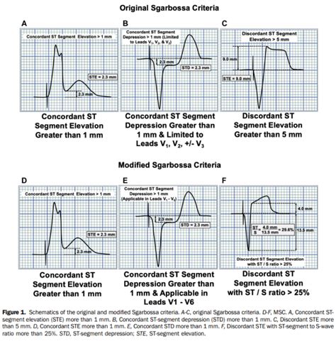 Modified Sgarbossa Criteria For Ventricular Paced Rhythms האיגוד הישראלי לרפואה דחופה