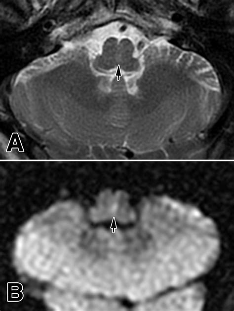 Anatomic And Mri Bases For Medullary Infarctions With Patients