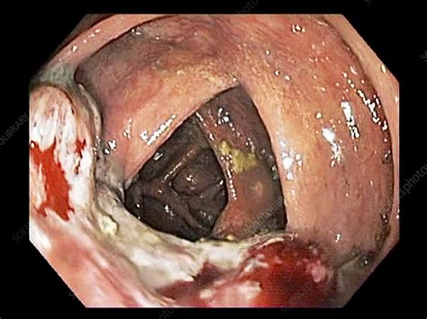 Colon Cancer Colonoscopy Colon Cancer Symptoms Causes Diagnosis