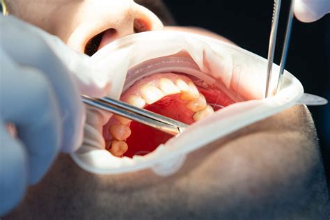 Dry Socket Risks Early Signs And At Home Care Tips