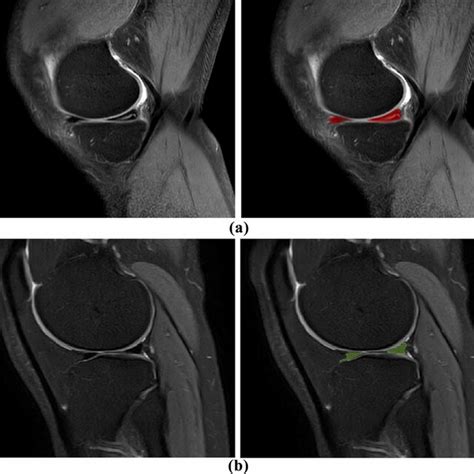 Clasificación Slap Snyder Visualización Artroscópica A Tipo I B Download Scientific