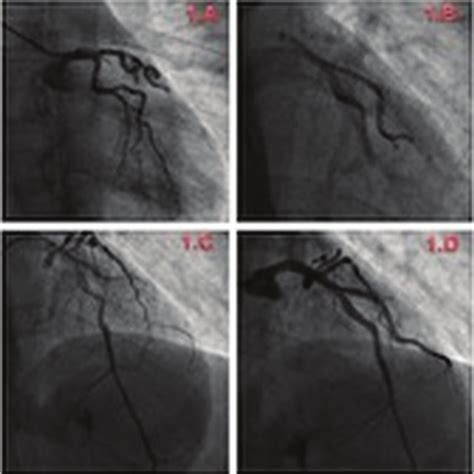 Procedure And Findings Of Iabp Removal Download Scientific Diagram