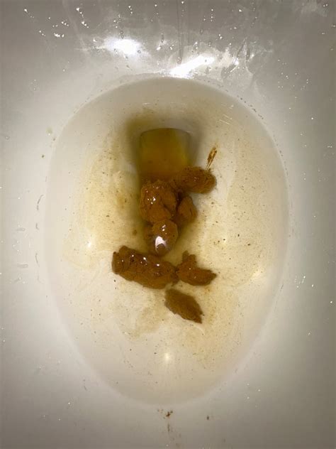 21125 Diarrhea Stomach Bug