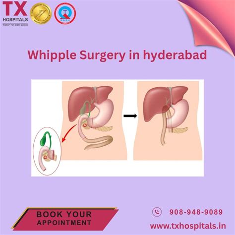 Whipple Surgery In Hyderabad A Life Saving Procedure At Tx Hospitals
