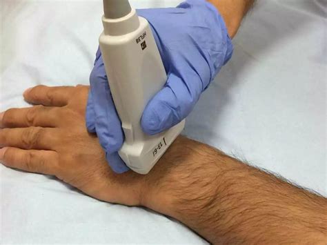 Nerve Conduction Testing And Ultrasound Now Together At East Neurology East Neurology