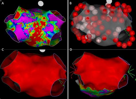 3d Electroanatomical Map Of The Left Atrial Posterior Wall Before Rf Download Scientific