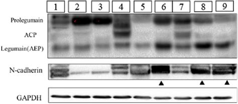 Correlation Analysis Of Legumain And N Cadherin In The Clinical Nb