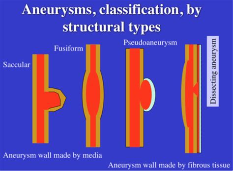 Pseudoaneurysm Vs Aneurysm