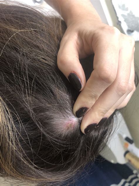 Progression Of Mrsa Cellulitis With Abcess Rpopping