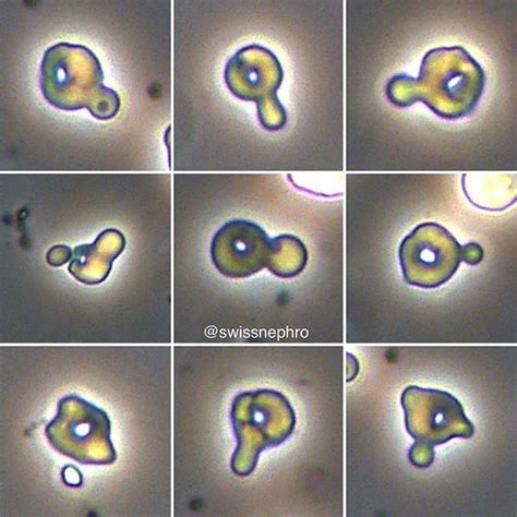 Acanthocytes Hallmark Of Glomerular Hematuria Phase Contrast Original