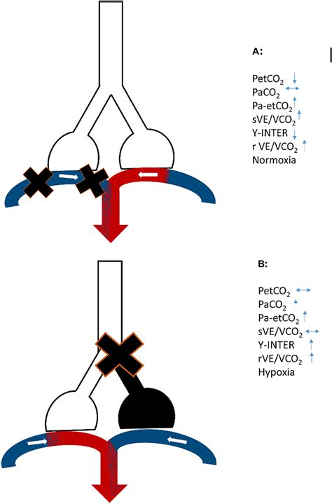 Ventilationperfusion Mismatch Panel A Ventilationperfusion