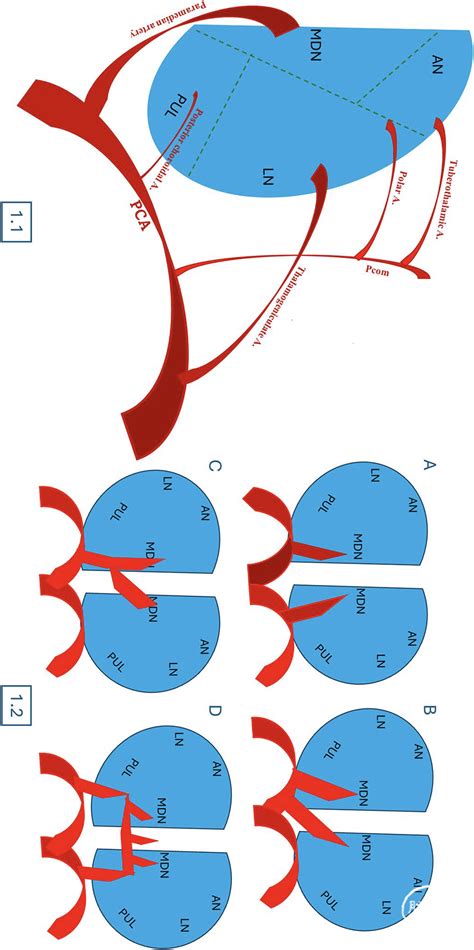 Neuroradiology：percheron动脉梗死的影像学鉴别诊断 脑医汇