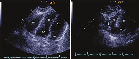 Tte Subcostal View Left Shows Moderate Encysted Anterior Pericardial