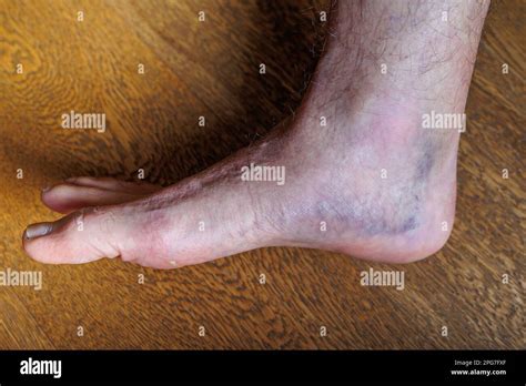 Ankle Injury Bruises