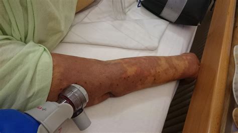 Sepsis Risk Factors Symptoms And Treatment