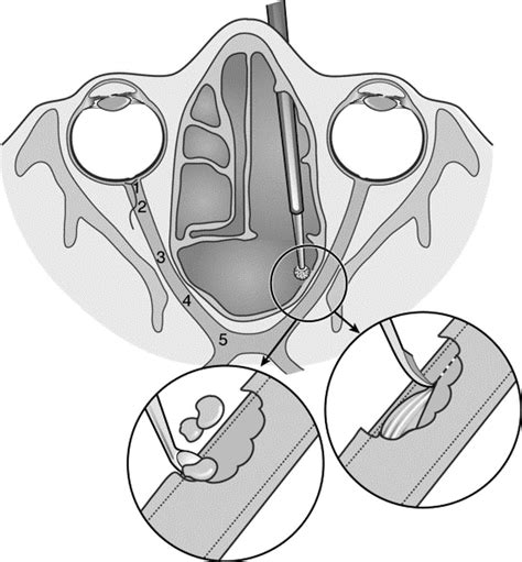 Ent Blogs Optic Nerve And Orbital Nerve Decompression