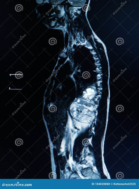 Mri Of The Thoracolumbar Spine A 30 Year Old Female Pressented With Retroperitoneal Massto