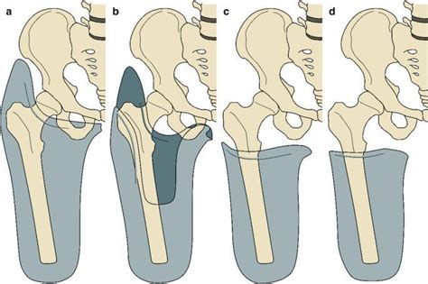 Ischial Containment Socket Workshop المؤسسة الهندسية Amman 13