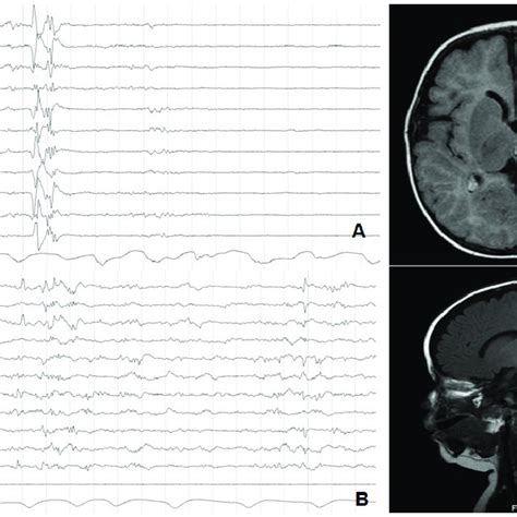Grading Of Thompson Score At Day 1 2 3 N84 Download Scientific