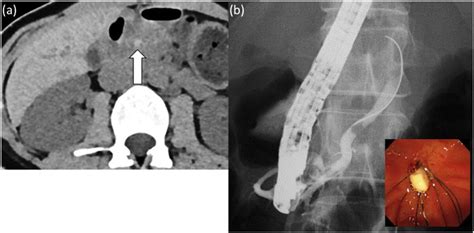 Annular Pancreas Ercp