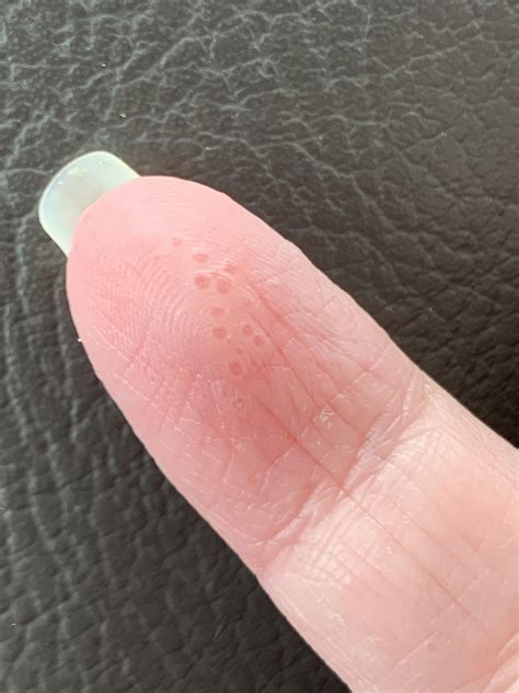 My Eczema Gives Some Serious Trypophobia Vibes Rmildlyinteresting