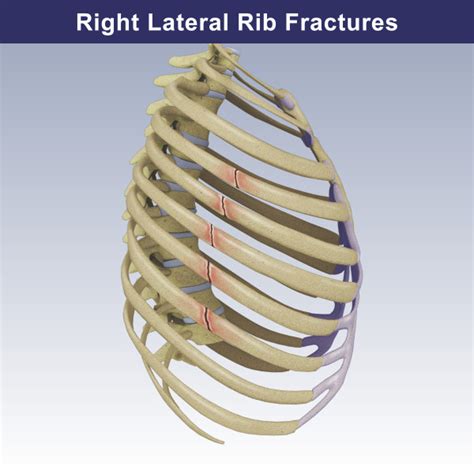 Fracture Of The Olecranon