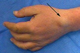 Ganglion Cyst Wrist