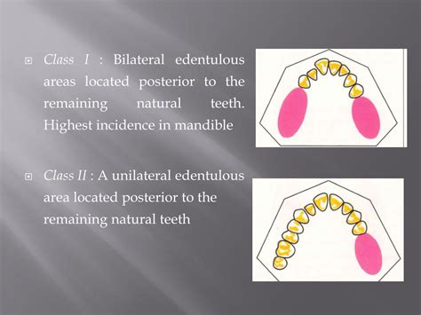 Ppt Partially Edentulous Arches Classification Powerpoint