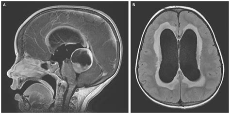 Hydrocephalus Mri Radiology