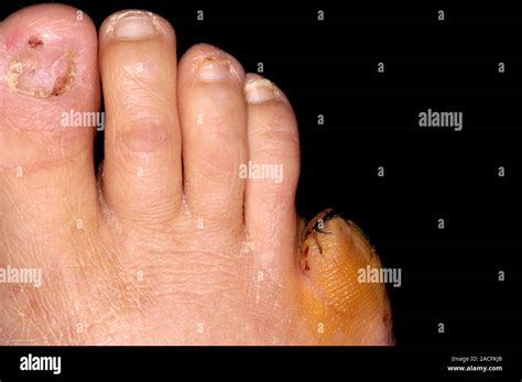 Amputated Toe Foot Of A 40 Year Old Woman With An Amputated Fifth Toe
