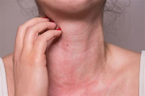 How Mcas Affects Sleep Sleeping Institute