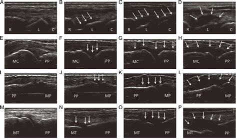 Ultrasounddetectable Grey Scale Synovitis Predicts Future Educational