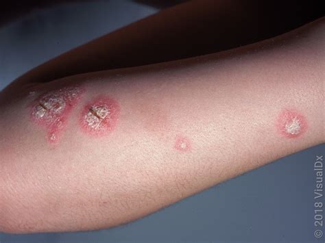 Heres What Psoriasis Looks Like Around The Body With Pictures Goodrx