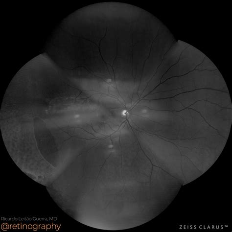 Degenerative Retinoschisis And Retinal Detachment Retinography