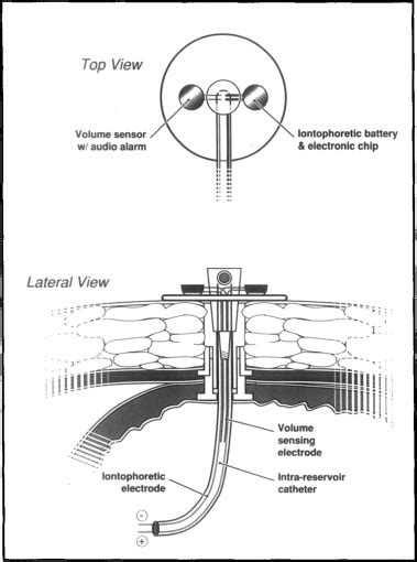 A Prosthetic Urinary Bladder—why Not Mayo Clinic Proceedings