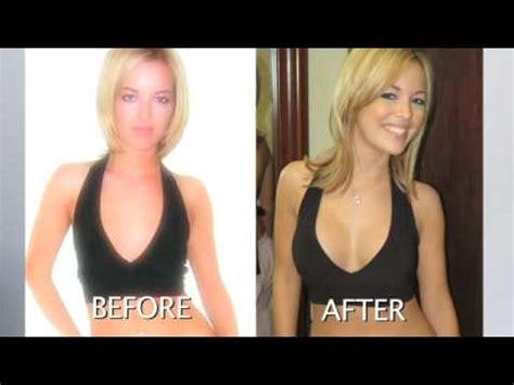 C Cup Before And After