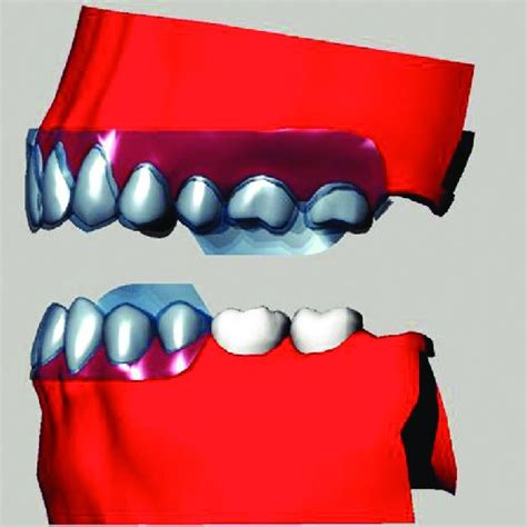 The Virtual Relationship Of The Bite Blocks Download Scientific Diagram