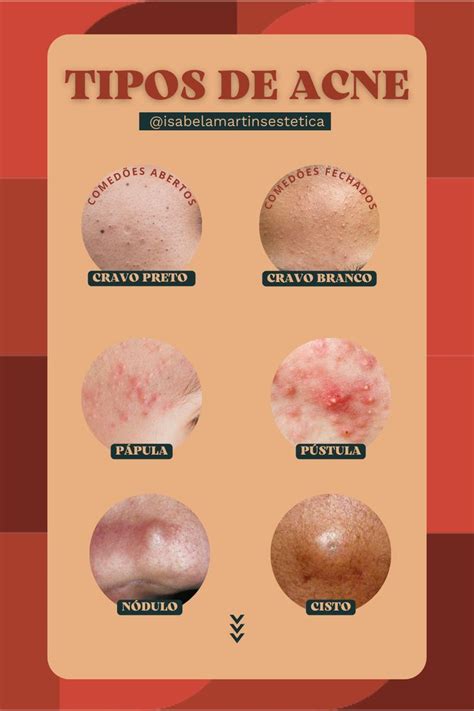 Tipos De Acne Bad Acne Skin Care Skin Care Routine