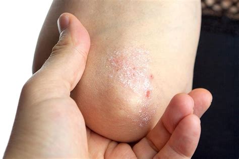 Psoriasis 101 Causes Symptoms And Treatments Explained