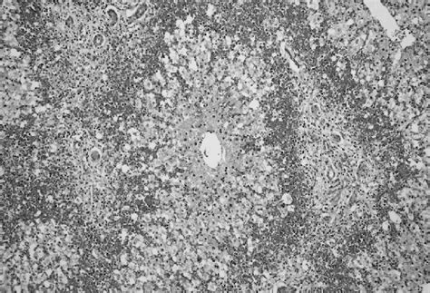 Necrose Hepatocelular Massiva Acentuada Associada à Hemorragia E