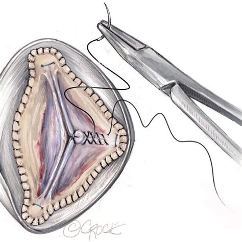 For Leaflet Repair Of A Bicuspid Valve Place One Stitch At The Edge Of